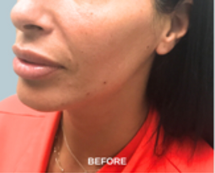 Patient #451 Sculptra-Midface Before and After Photos Miami, FL ...