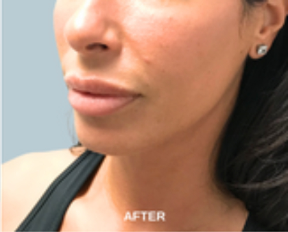 Patient #451 Sculptra-Midface Before and After Photos Miami, FL ...