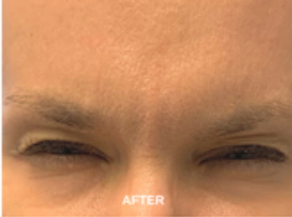 Patient #438 Glabella Before and After Photos Miami, FL - Plastic ...